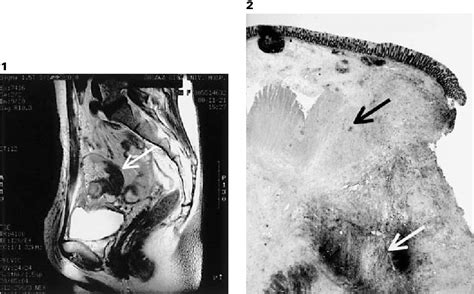 Figure 1 From A Perforated Sigmoid Diverticulum Abscess Difficult To Differentiate From An