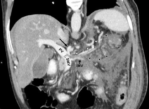 Splenic Vein Thrombosis—caught In The Middle The American Journal Of