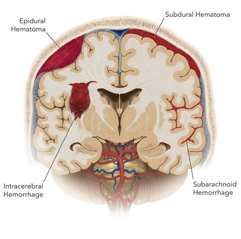 Subdural Hematoma Vs Subarachnoid Hemorrhage