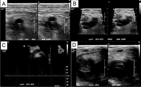 How Point Of Care Ultrasound Led To A Diagnosis Of May Thurner Syndrome