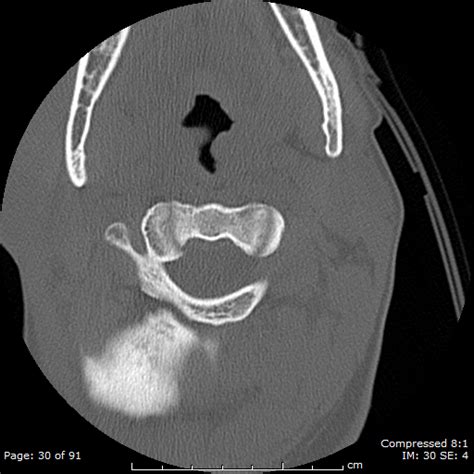Calcium Pyrophosphate Dihydrate Deposition Disease Radiopaedia 25455