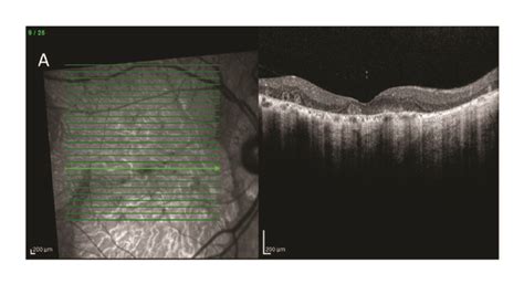 A And B Sdoct Shows Outer Retinal And Choriocapillaris Atrophy With Download Scientific