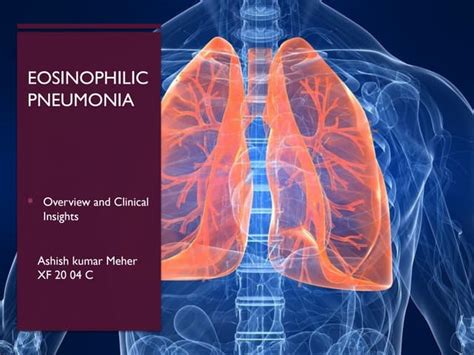 Eosinophilicpneumoniadetailedpresentation 1pptx