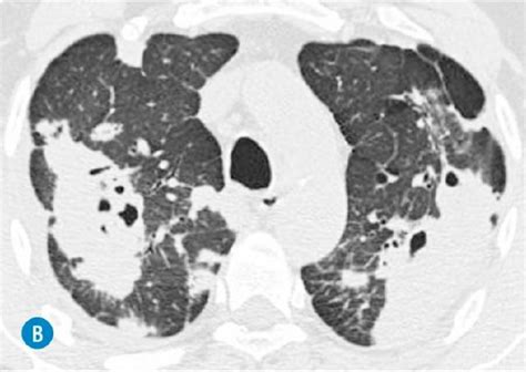 Pneumonia Fúngica Conceito Etiologia Sintomas E Tratamento Medway