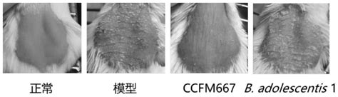 Bifidobacterium Adolescentis Capable Of Relieving Psoriasis And Application Thereof Eureka