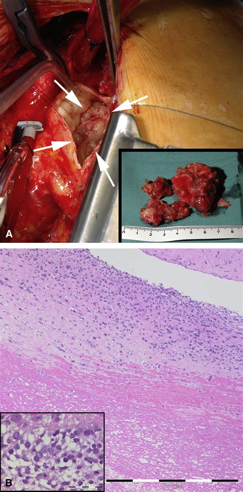 Primary Intimal Pulmonary Artery Sarcoma A Diagnostic Challenge The