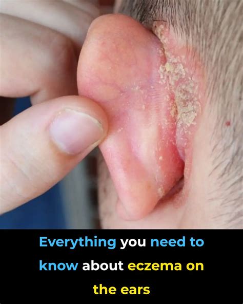 Everything You Need To Know About Eczema On The Ears