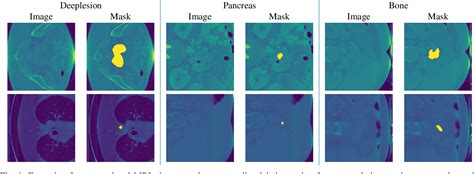 Figure 1 From Optimizing Universal Lesion Segmentation State Space Model Guided Hierarchical