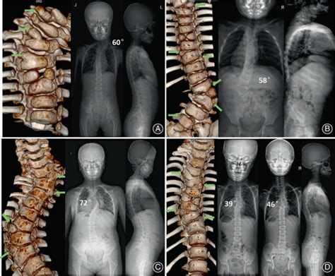 Multiple Hemivertebrae The Natural History And Treatment Of 50