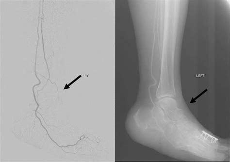 Angiogram Of Left Distal Leg And Foot Showing Poor F Low Of The Distal
