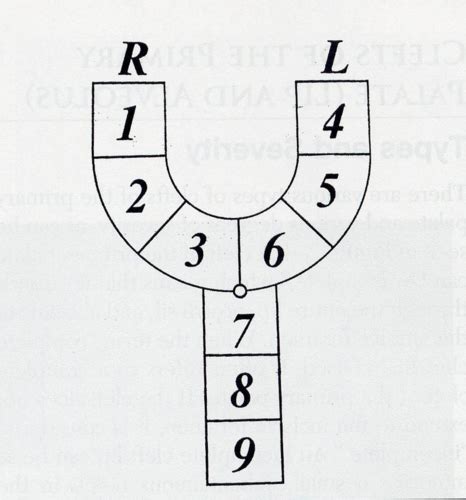 Classification Of Cleft Lip And Palate Flashcards Quizlet