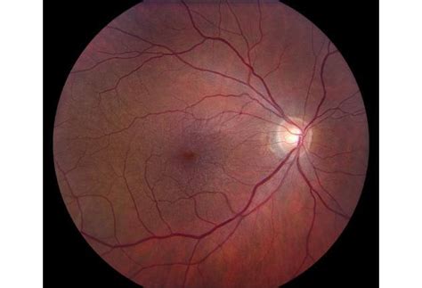 Macular Pucker Treatment Wills Eye Hospital Philadelphia Pa