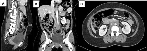 Transvenous Biopsy Of Abdominal Pelvic Lesions With No Safe
