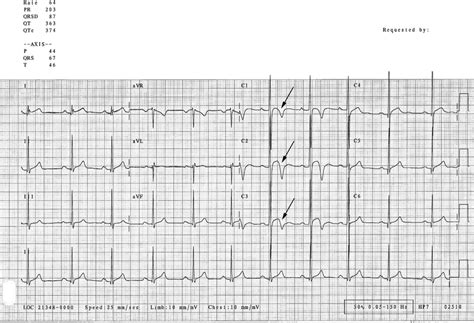 Abbreviation Ecg Electrocardiogram Download Scientific Diagram