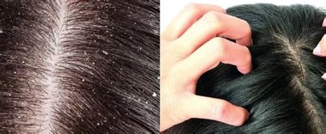 Maxaa Sababo Cuncunka Iyo Agoolka Sidee Loo Daweyaa Maxaa Sababo Cuncunka Iyo Agoolka