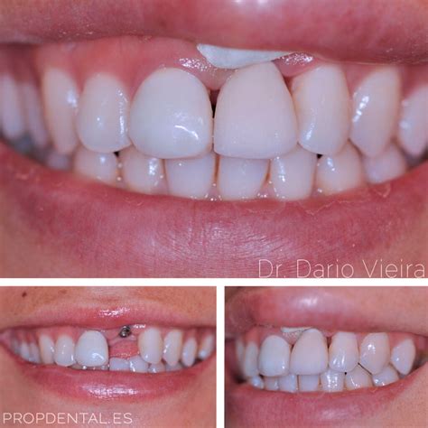 Diente Postizo Provisional Para Implante Dental