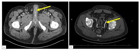 A Non Contrast Ct Scan Showing Extensive Calcification Of The