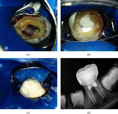 The Management Of Hyperplastic Pulpitis In Immature Permanent Molar