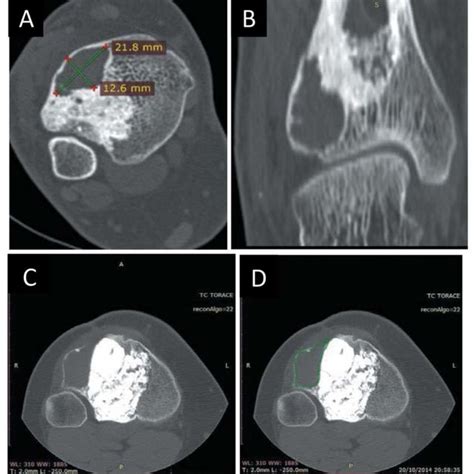 Anteroposterior Radiograph Shows A Lytic Lesion In The Distal Tibia