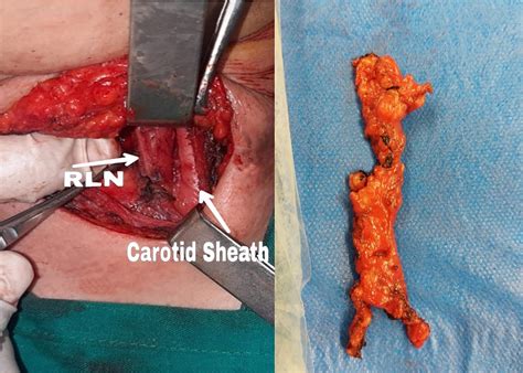 Prophylactic Central Neck Dissection For Papillary Thyroid Carcinoma Comparison Of Unilateral