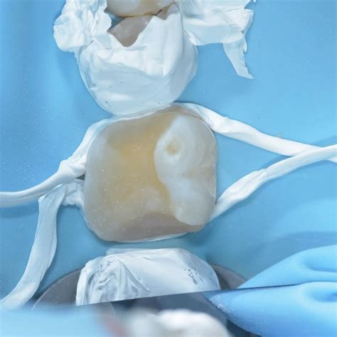 Deep Margin Elevation And Biologic Width — Alleman Center Of Biomimetic