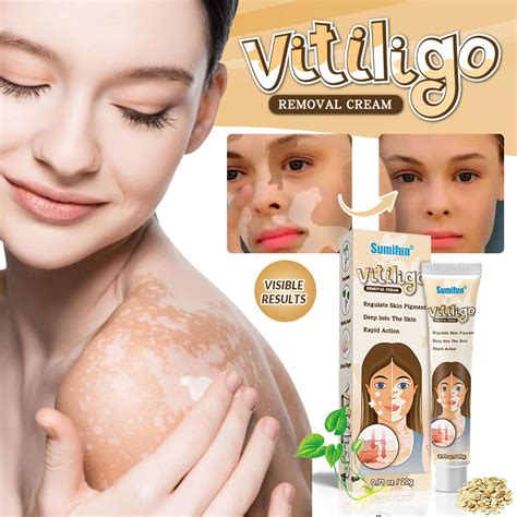 🔥 100 Effective 🔥 Sumifun Vitiligo Antibacterial Treatment Cream 20g