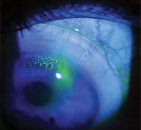 Navigating The Scleral Lens Maze