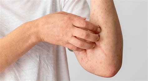 Ingrown Hair Staph Infection