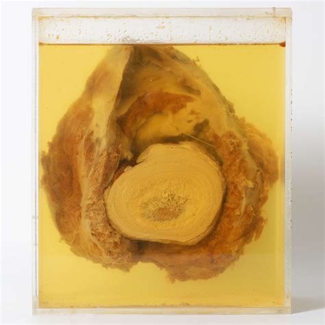 An Extraordinarily Large Cut Section Of A Gall Stone And Bladder