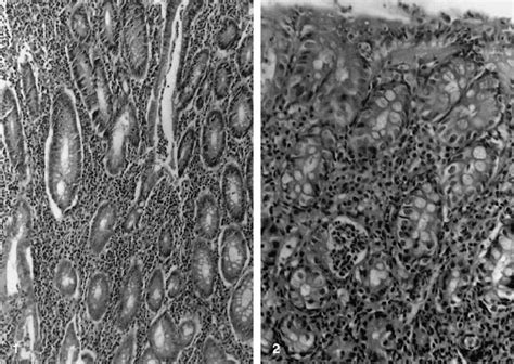 Colonic Biopsy From A Patient With Segmental Colitis Associated With Download Scientific