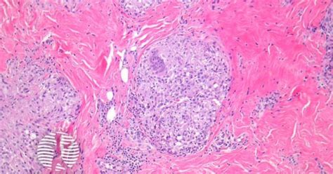 Leprosy Pathology Image