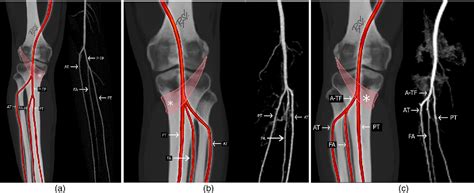 Figure 1 From Popliteal Artery Branching Variations On Computed Tomography Angiography Of 1542