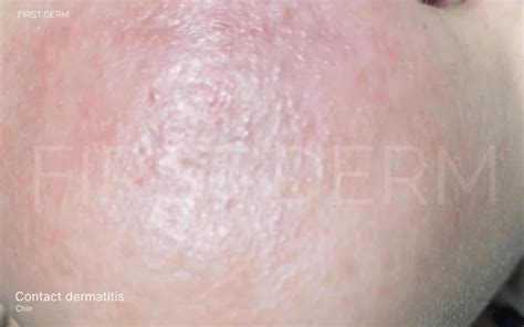 Dry Skin Patches On Face