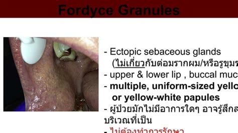 Normal Variation Pptx