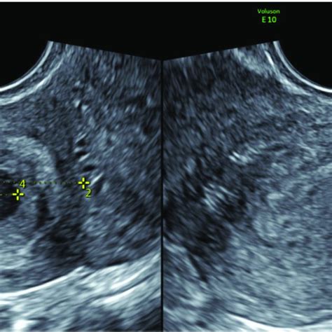 Figo Classification Of Causes Of Aub Palm Coein Download