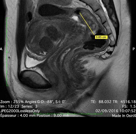 Full Time Disc Excision In A 4cm Large Endometriosis Nodule Of The Rectum