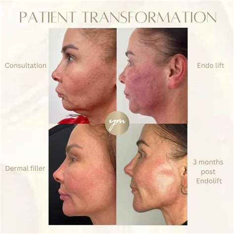 Endolift The Best Non Surgical Facelift In Liverpool