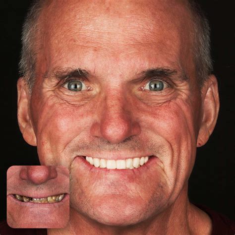 Doctors Implants Full Mouth Dental Implants