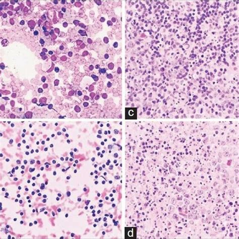 Fna Smear And Histology Of 4 × 3 Cm Right Cervical Lymph Node Of 2