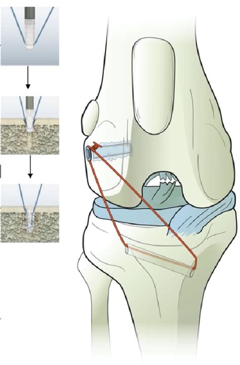 Figure 1 From Comparison Of Extracapsular Stabilization Techniques
