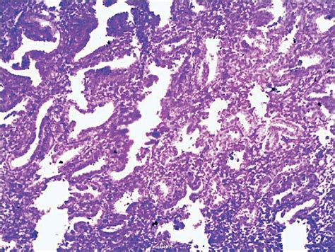Photomicrograph Showing Endometrial Glands With Complex Hyperplasia