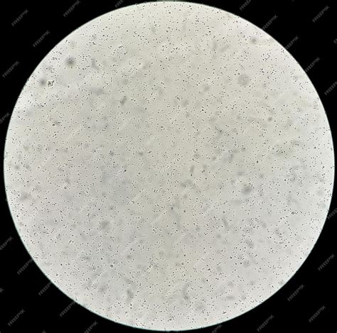 Premium Photo Semen Analysis Under Microscopy Showing Pyospermia Or Leukocytospermia Sperm