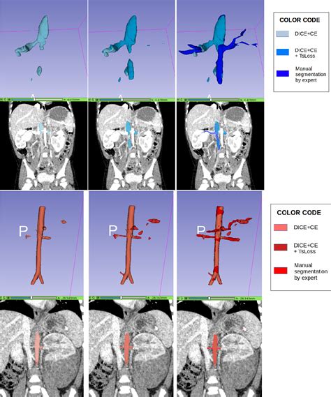 Figure 1 From Tubular Structures Segmentation Of Pediatric Abdominal