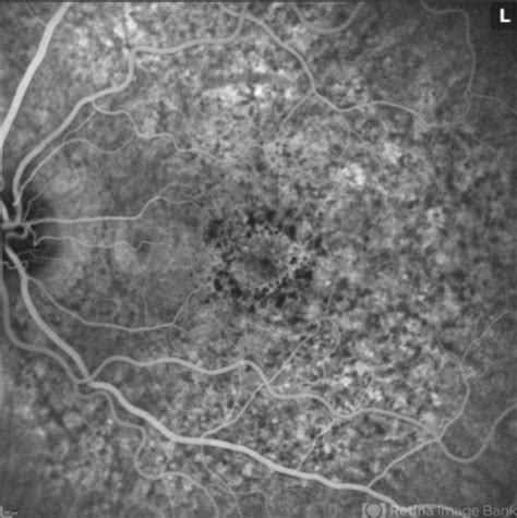 Pentosan Polysulfate Maculopathy Diagnosis And Management