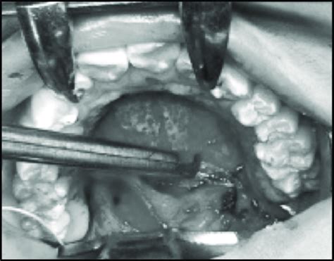 Palatal Incision Extended To The Ipsilateral Tonsillar Pillar Download Scientific Diagram