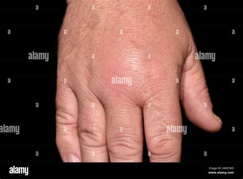 Gout Of The Metacarpophalangeal Mcp Joint Of A 54 Year Old Man Gout Is A Condition In Which Gout Of The Metacarpophalangeal Mcp Joint Of A 54 Year Old Man Gout Is A Condition In Which