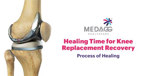 Knee Replacement Recovery Recovery And Beyond What To Expect After