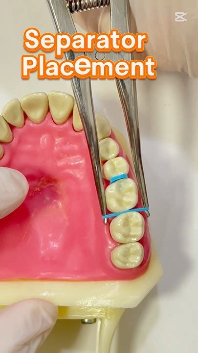 Separator Placement And Band Cementing Teeth Dentist Orthodontics