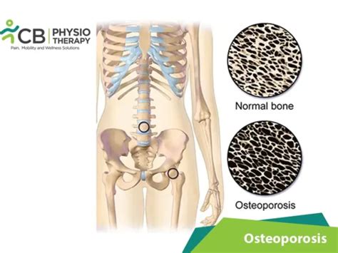 Top 5 Exercises For Osteoporosispng