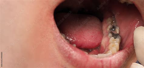 Decayed Tooth Root Canal Treatment Tooth Or Teeth Decay Of Lower Molar